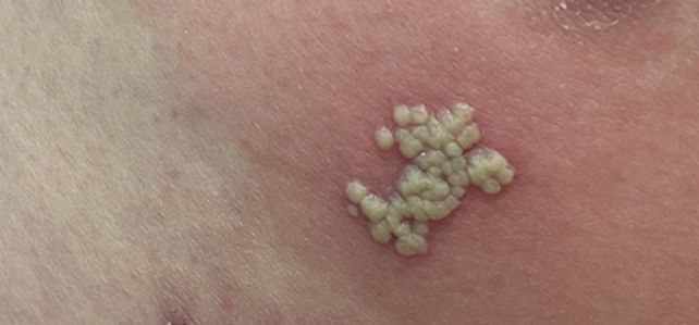 Medical Case: What is behind this recurrent "shingles"?